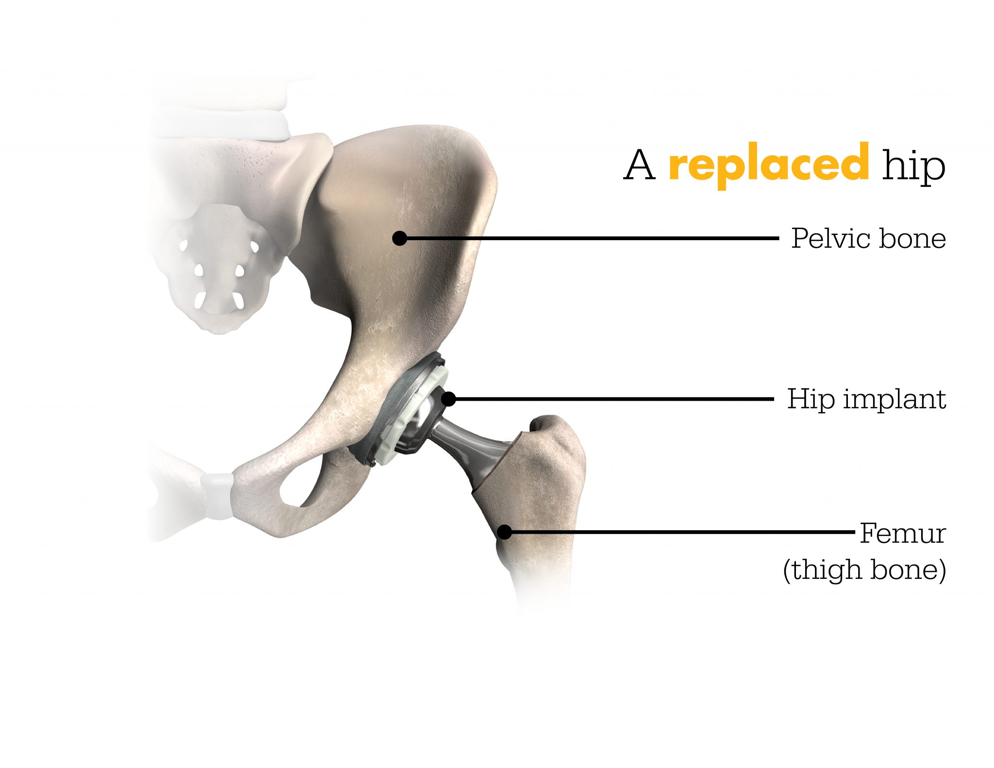 MAKO Robotic Total Hip Replacement | Dr. Shahin S. Rad