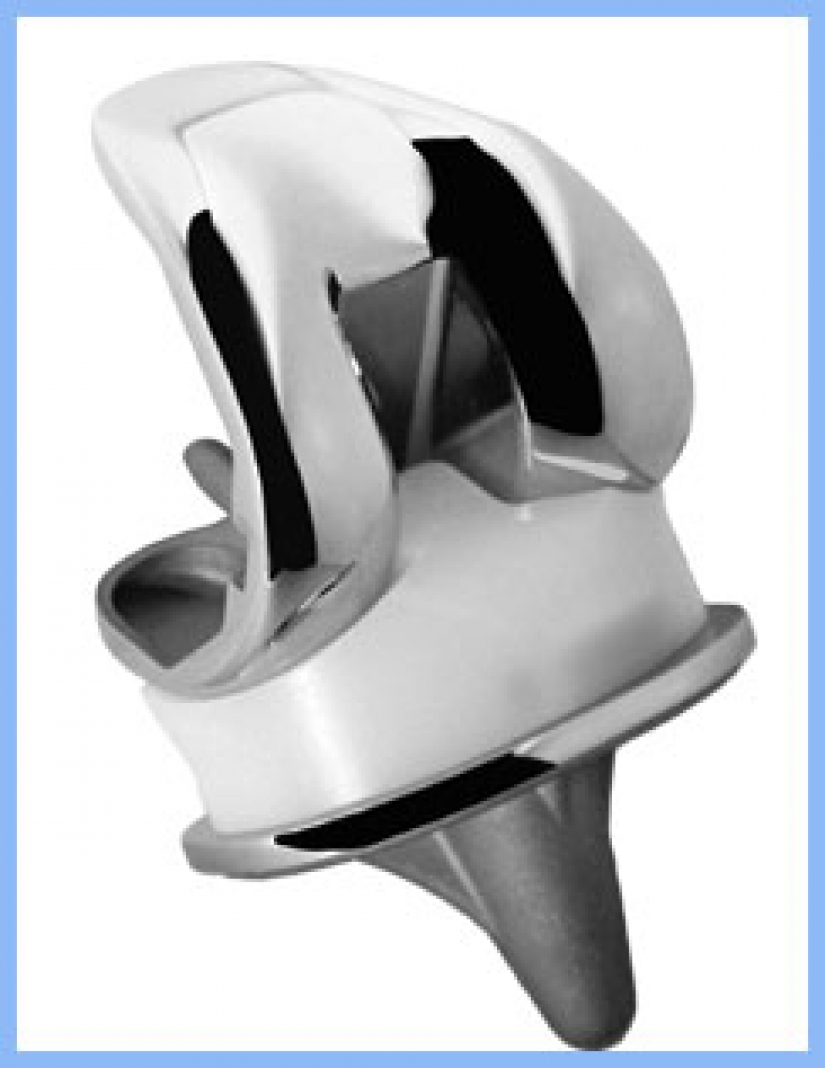 How Long Will My Knee Replacement Last Dr Shahin S Rad